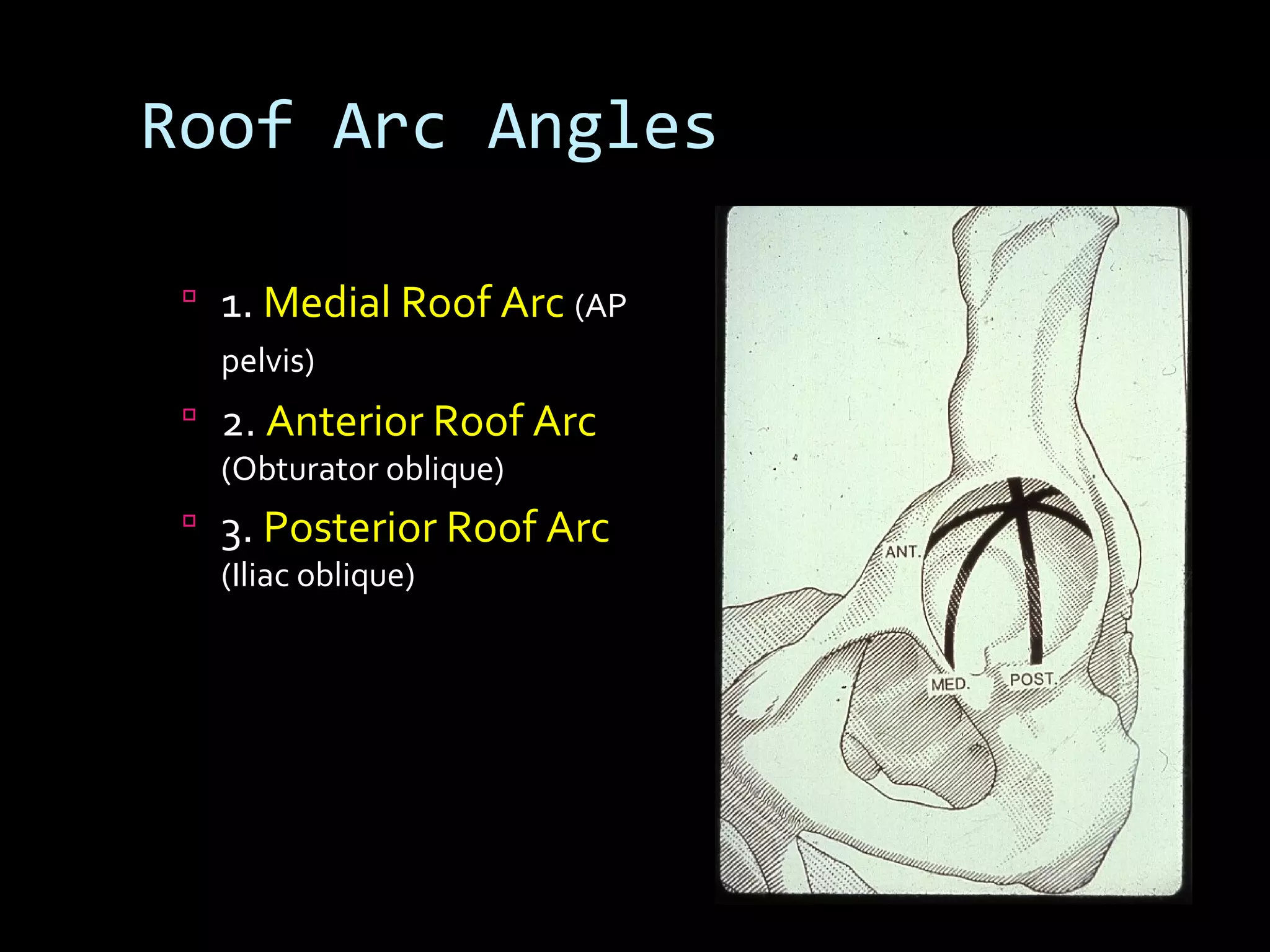 acetabular fracture | PPT