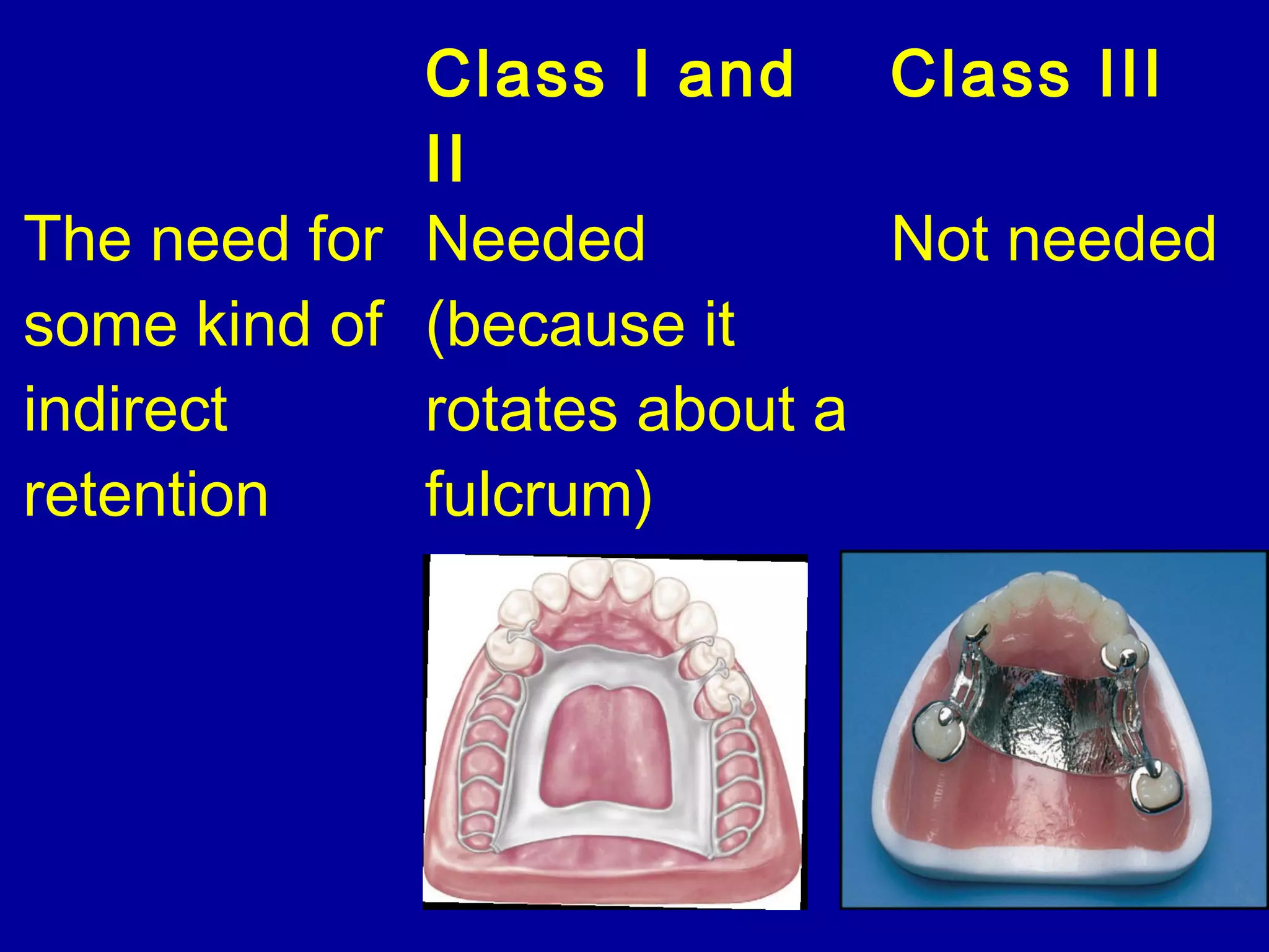 26. designing of rpd | PPT
