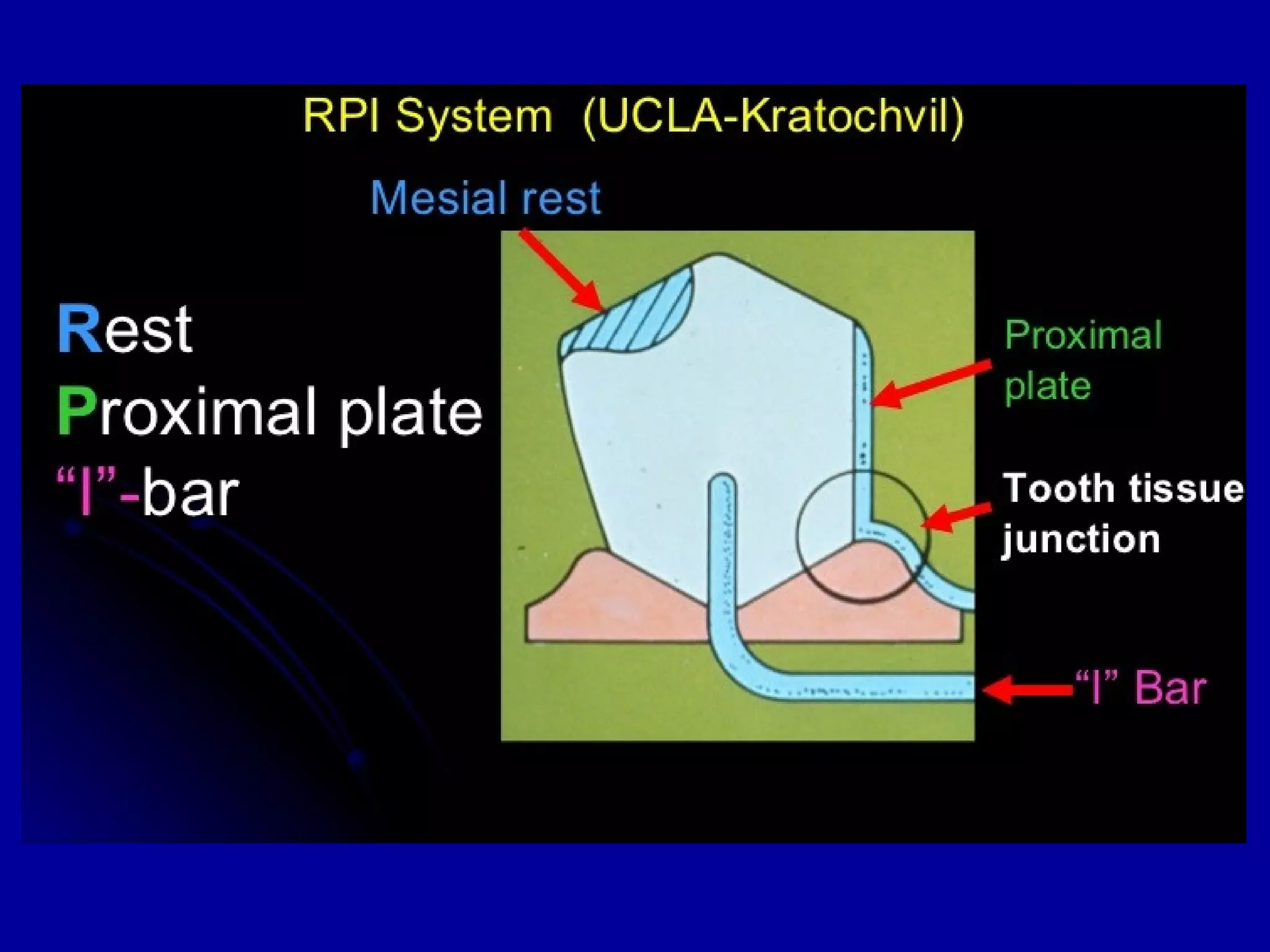 26. designing of rpd | PPT