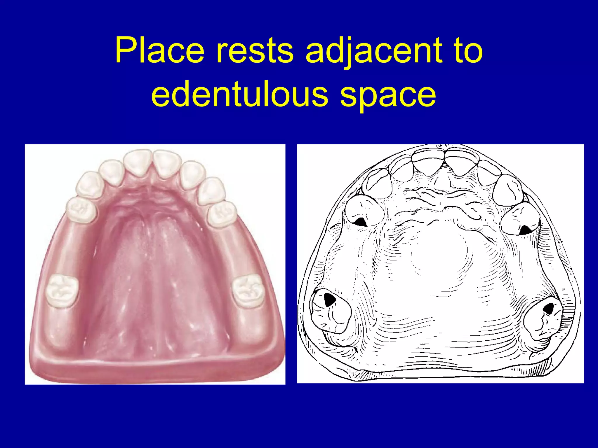 26. designing of rpd | PPT