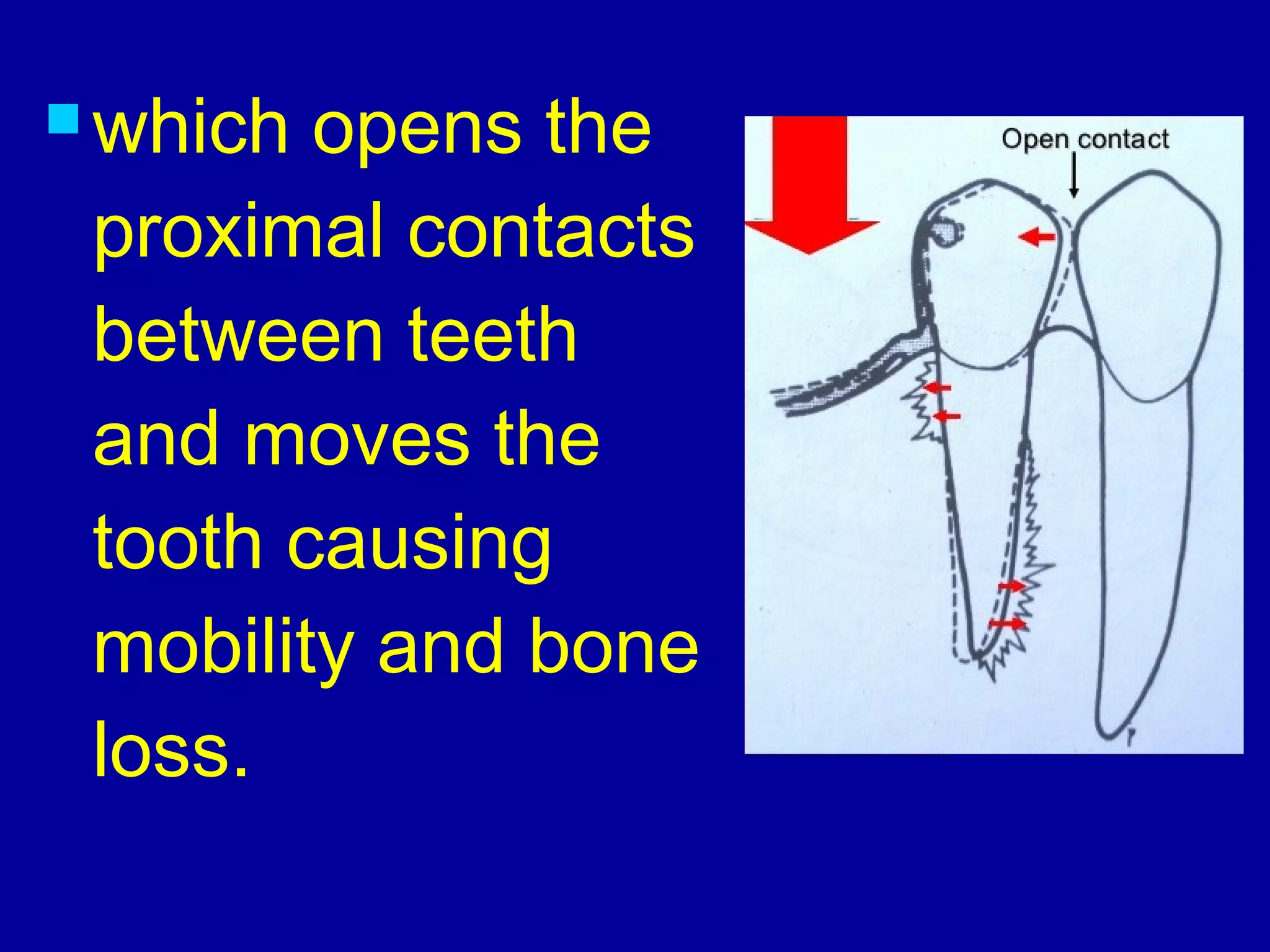 26. designing of rpd | PPT