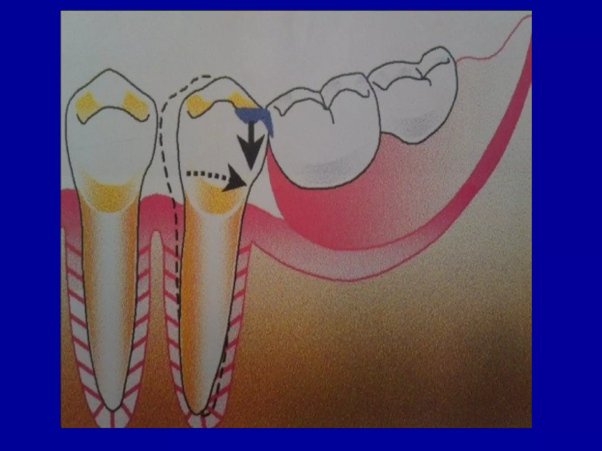 26. designing of rpd | PPT