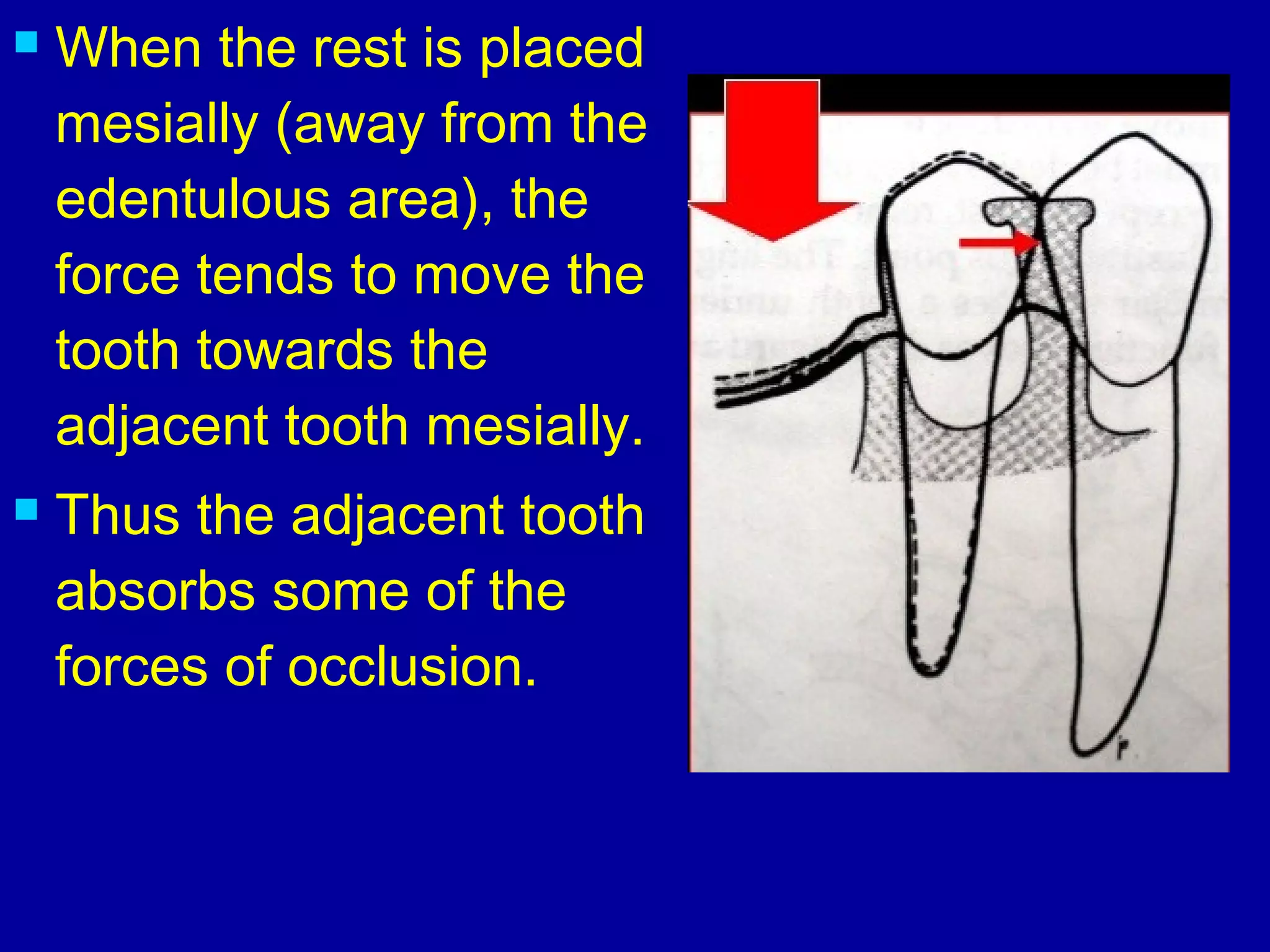 26. designing of rpd | PPT