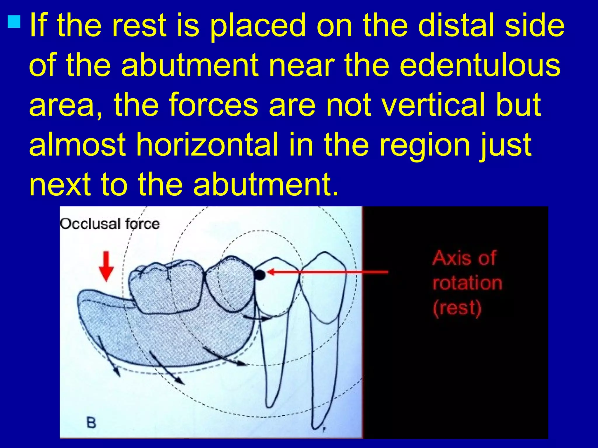 26. designing of rpd | PPT