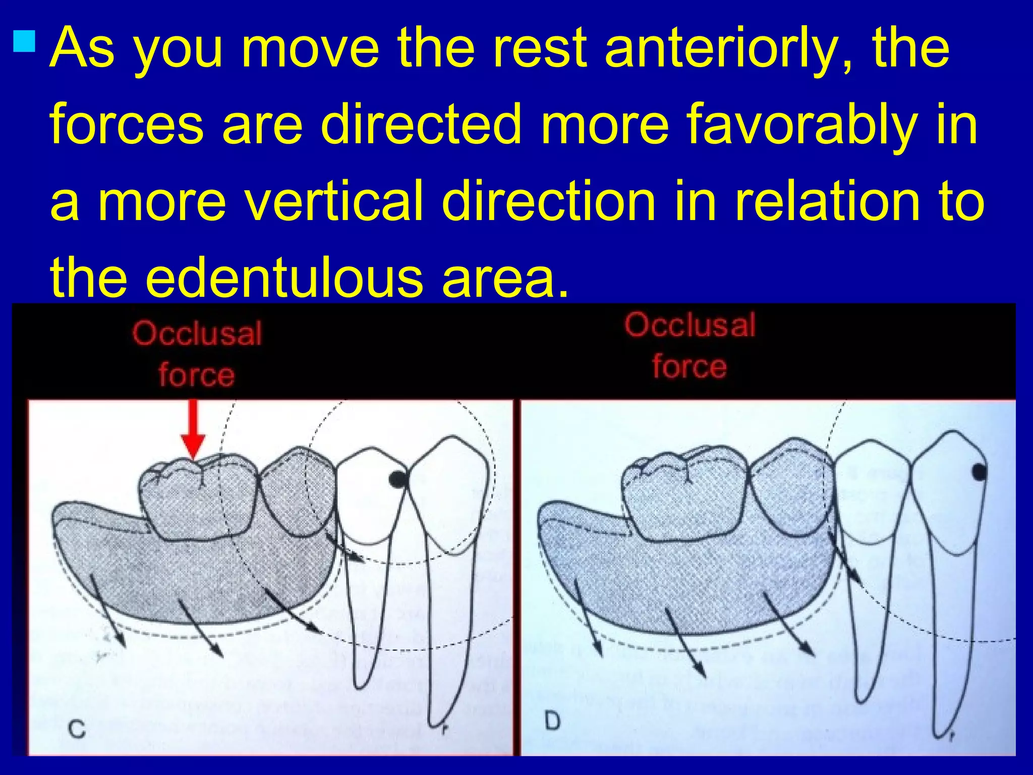 26. designing of rpd | PPT