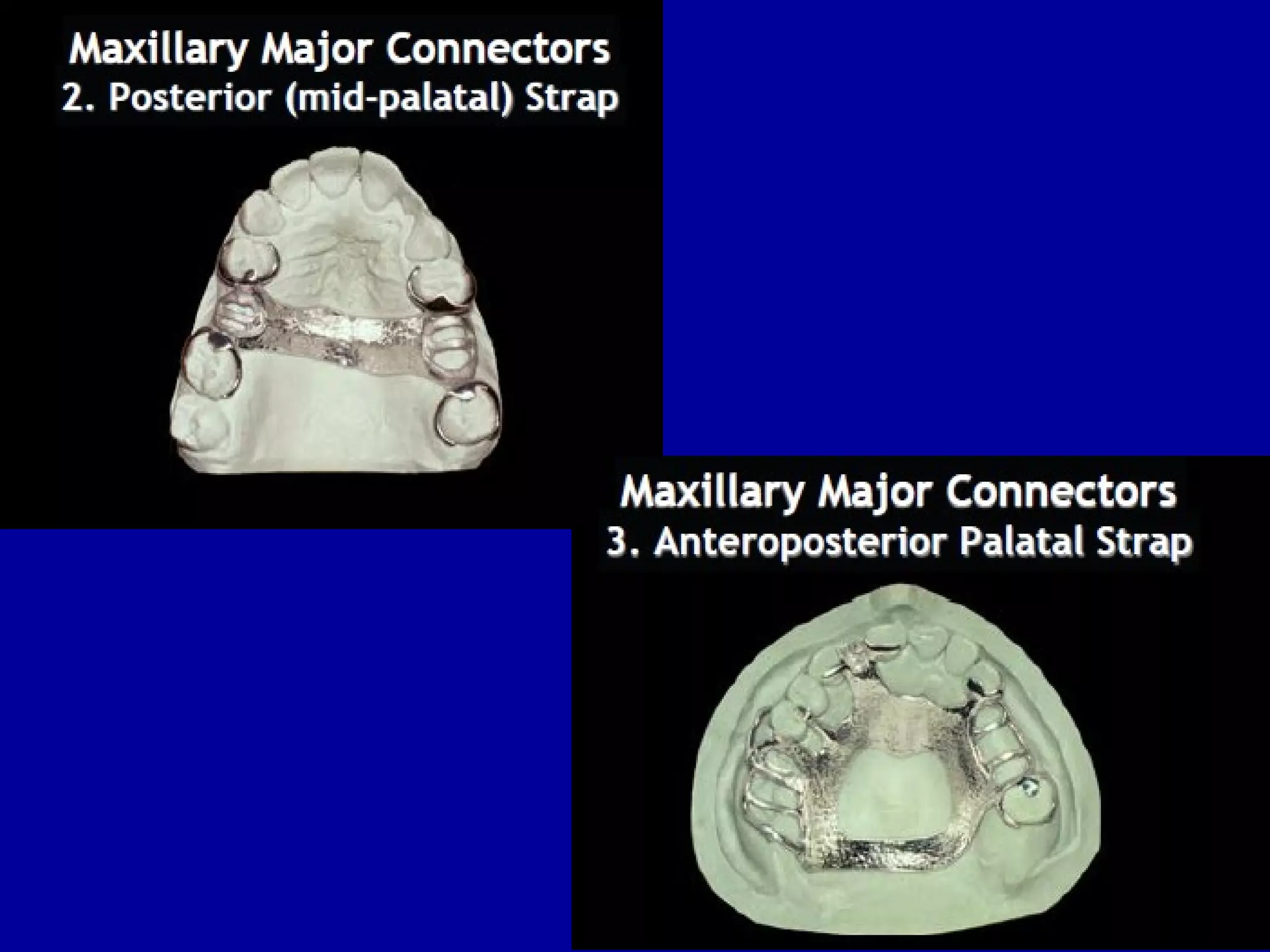 26. designing of rpd | PPT
