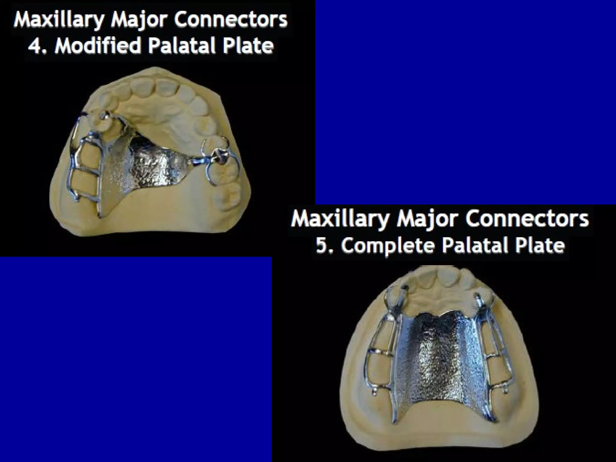 26. designing of rpd | PPT