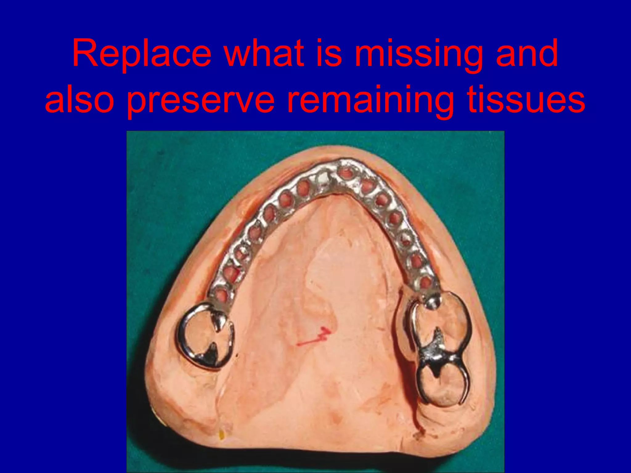 26. designing of rpd | PPT