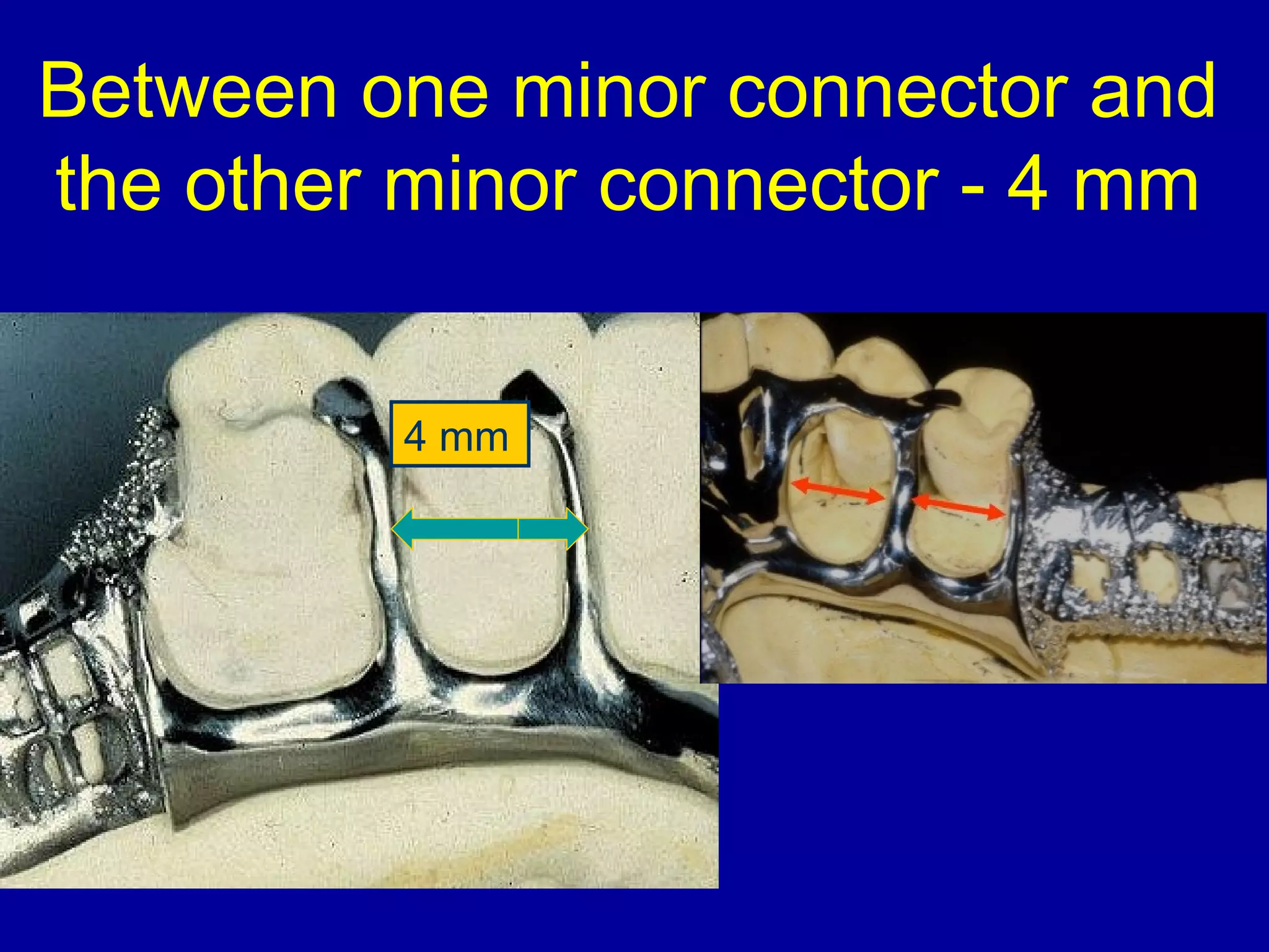 26. designing of rpd | PPT
