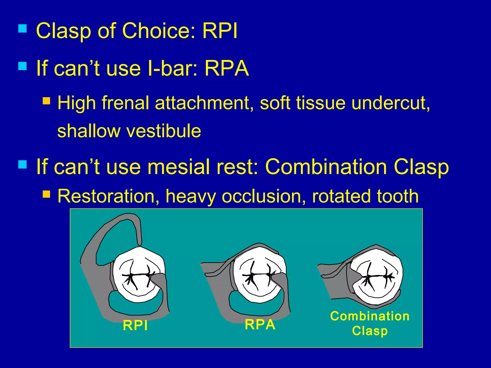 26. designing of rpd | PPT