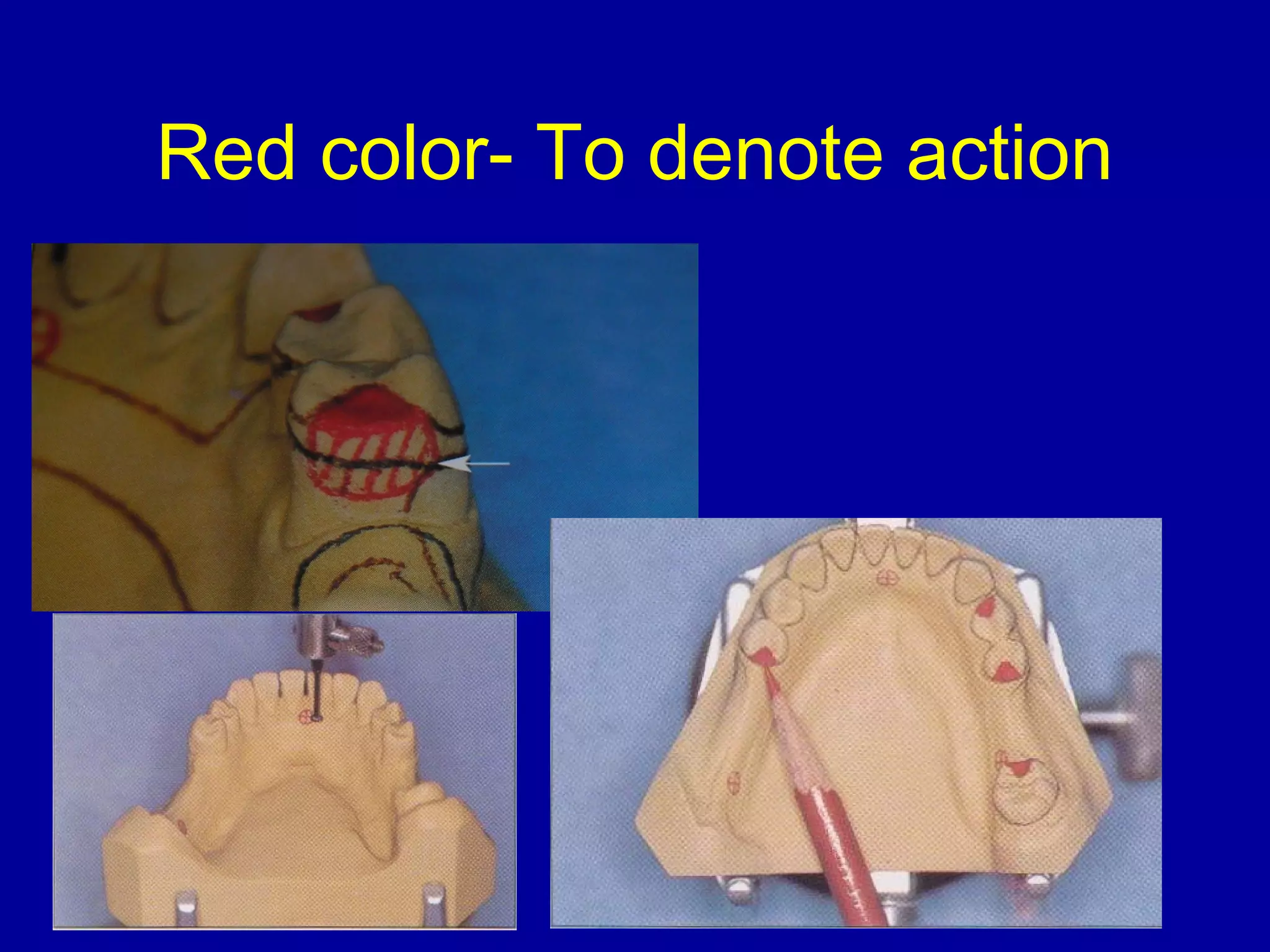 26. designing of rpd | PPT