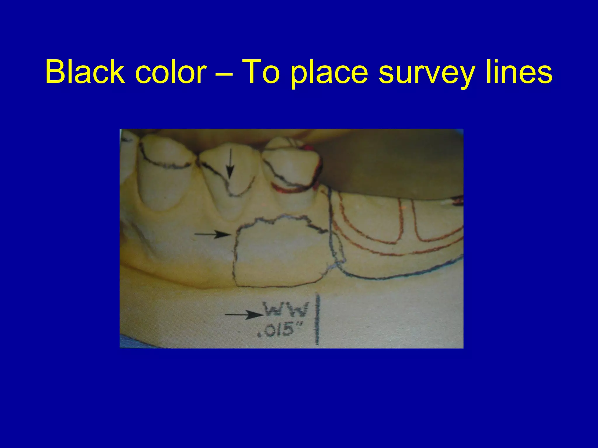 26. designing of rpd | PPT