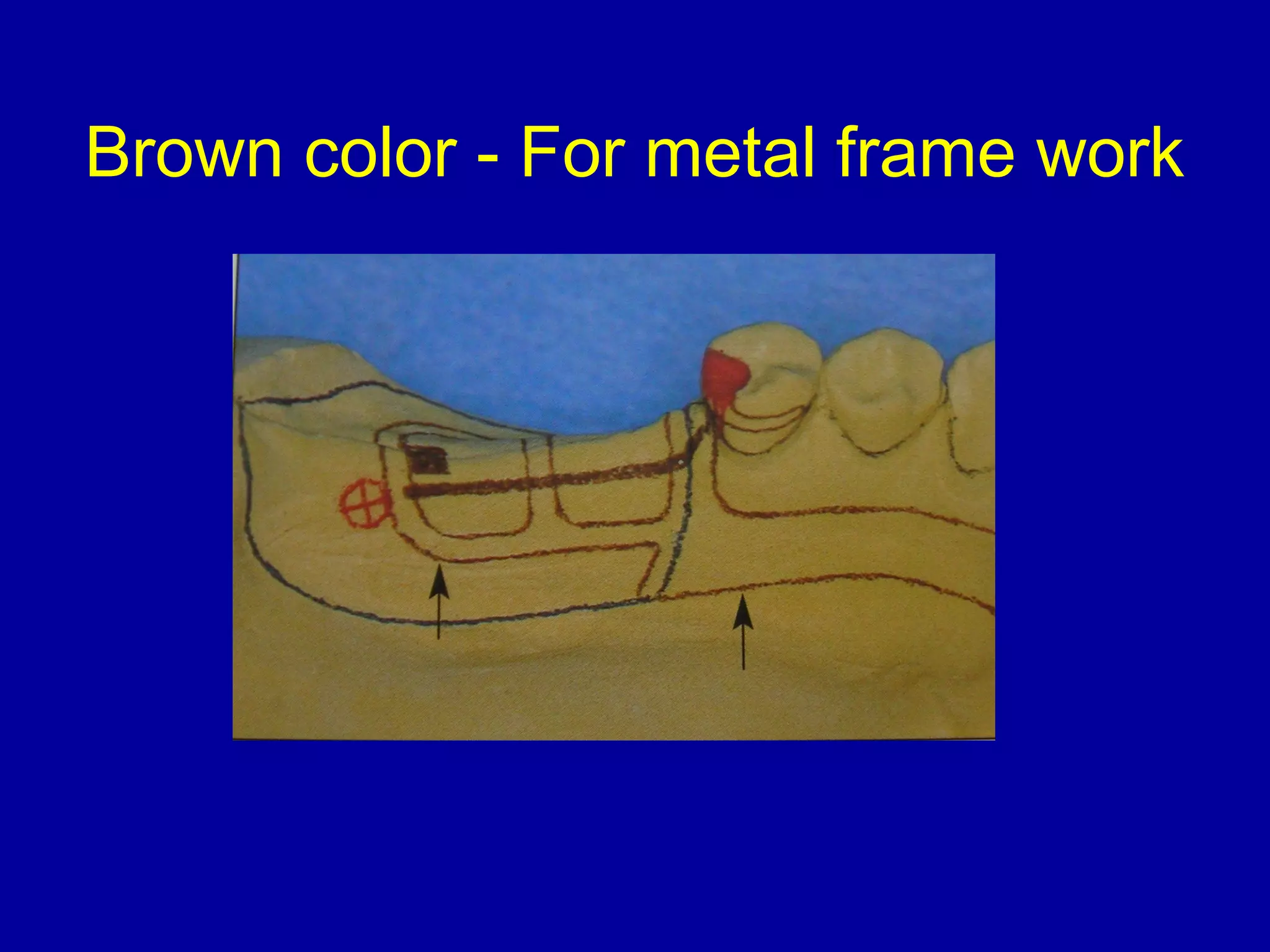 26. designing of rpd | PPT