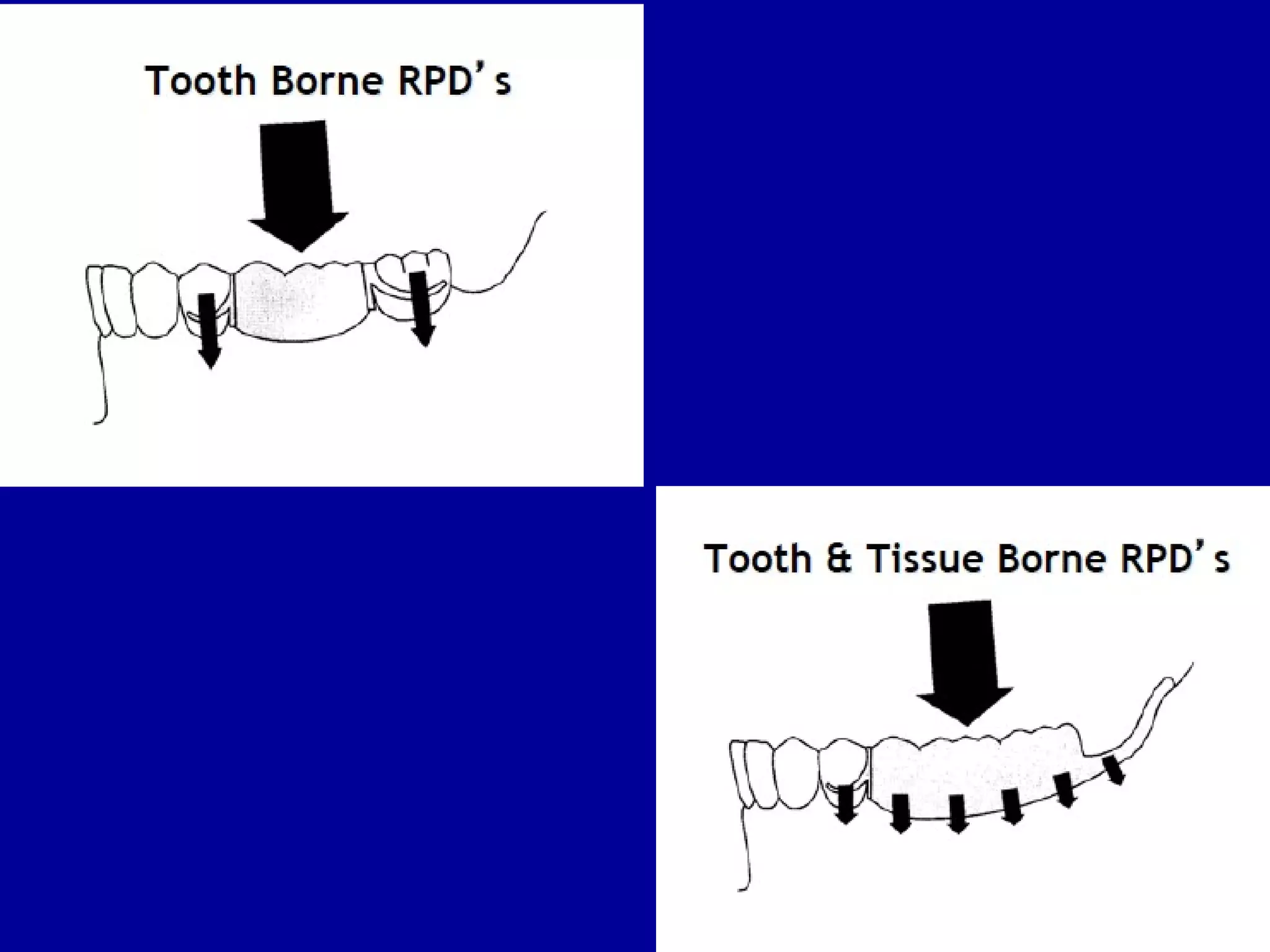 26. designing of rpd | PPT