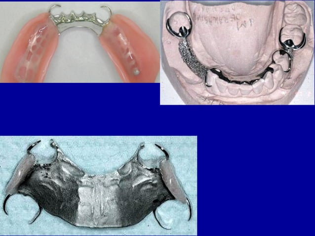 26. designing of rpd | PPT | Dental Health | Diseases and Conditions