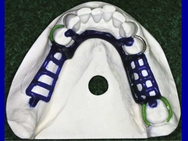 26. designing of rpd | PPT | Dental Health | Diseases and Conditions