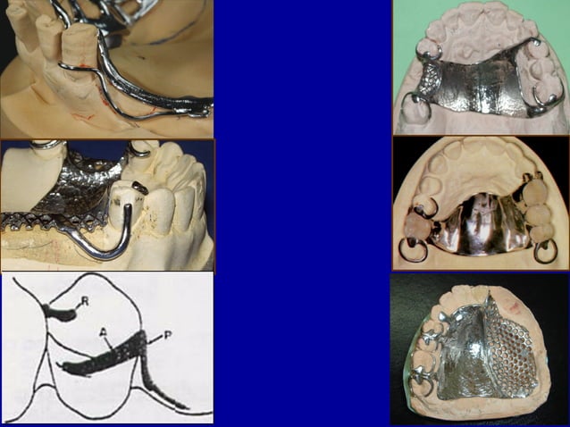 26. designing of rpd | PPT | Dental Health | Diseases and Conditions