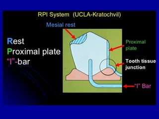 26. designing of rpd | PPT