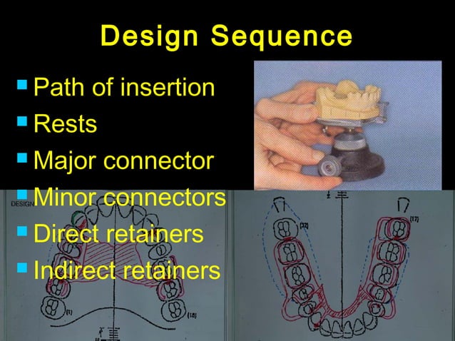 26. designing of rpd | PPT | Dental Health | Diseases and Conditions