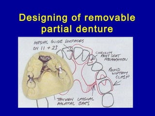 26. designing of rpd | PPT