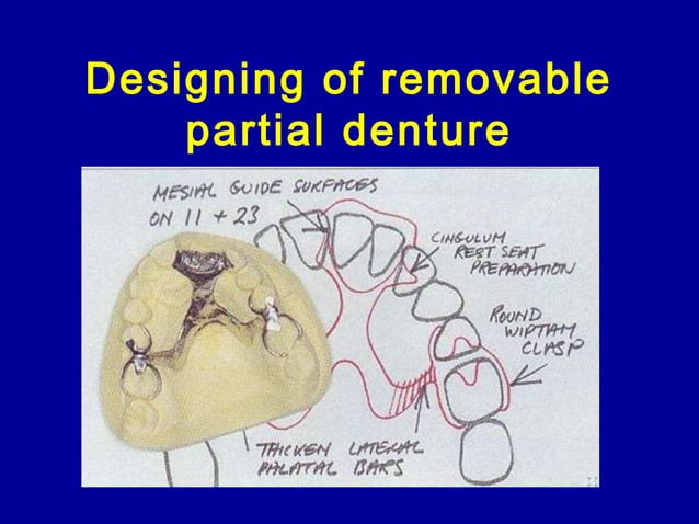 26. designing of rpd | PPT | Dental Health | Diseases and Conditions