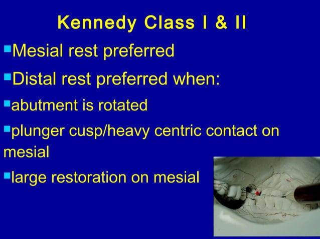 26. designing of rpd | PPT | Dental Health | Diseases and Conditions