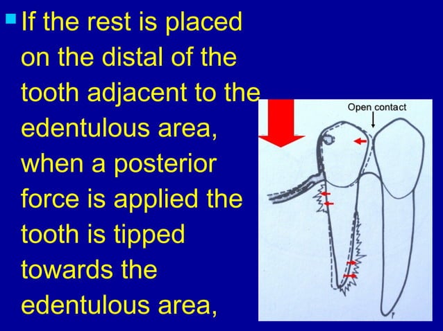 26. designing of rpd | PPT | Dental Health | Diseases and Conditions
