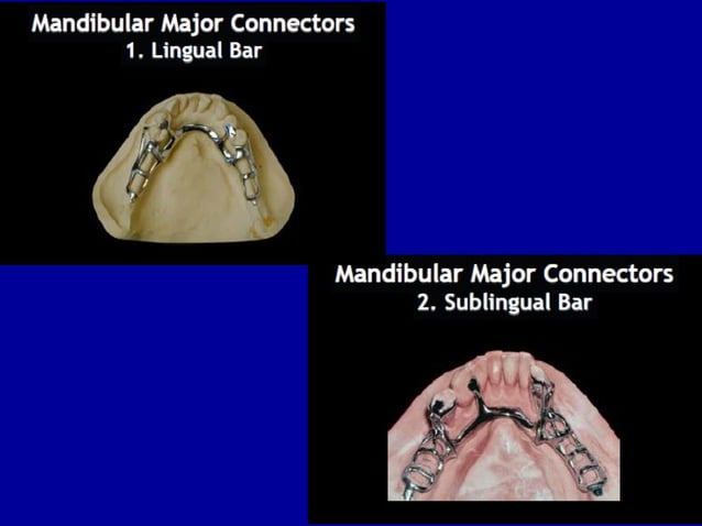 26. designing of rpd | PPT | Dental Health | Diseases and Conditions