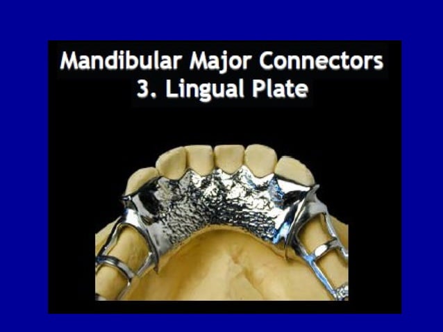 26. designing of rpd | PPT | Dental Health | Diseases and Conditions