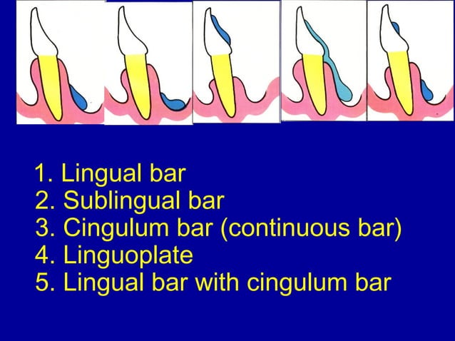 26. designing of rpd | PPT | Dental Health | Diseases and Conditions