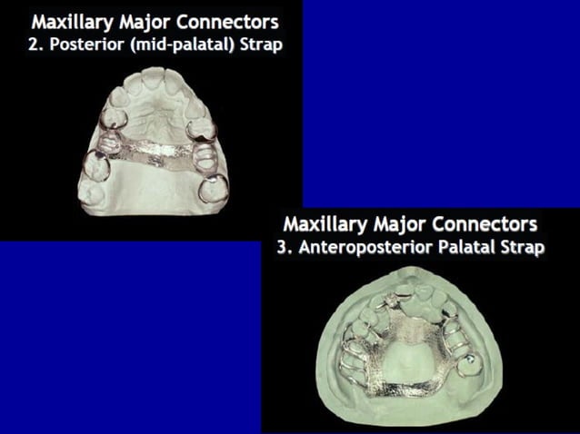 26. designing of rpd | PPT | Dental Health | Diseases and Conditions