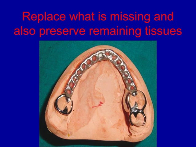 26. designing of rpd | PPT | Dental Health | Diseases and Conditions