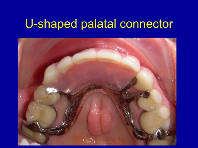 26. designing of rpd | PPT | Dental Health | Diseases and Conditions