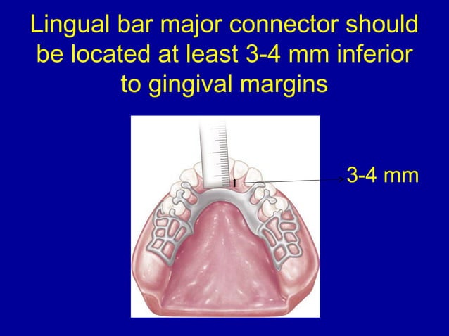 26. designing of rpd | PPT | Dental Health | Diseases and Conditions