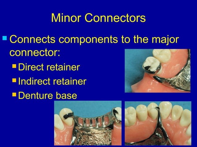 26. designing of rpd | PPT | Dental Health | Diseases and Conditions