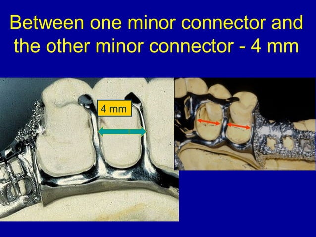 26. designing of rpd | PPT | Dental Health | Diseases and Conditions