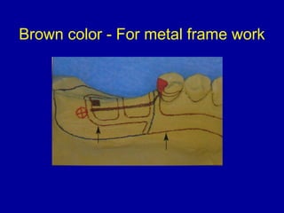 26. designing of rpd | PPT