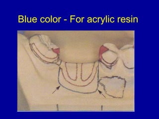 26. designing of rpd | PPT