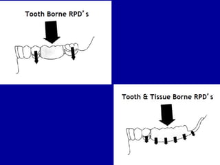 26. designing of rpd | PPT