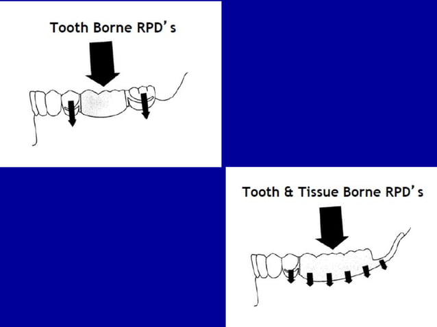 26. designing of rpd