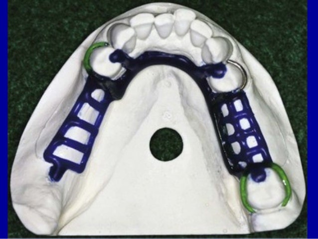 Kennedy Class 1 Rpd Design Mandibular