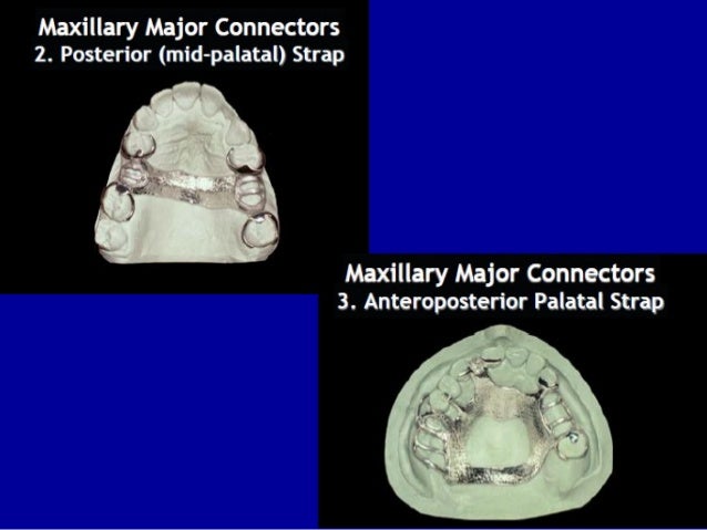 26. designing of rpd