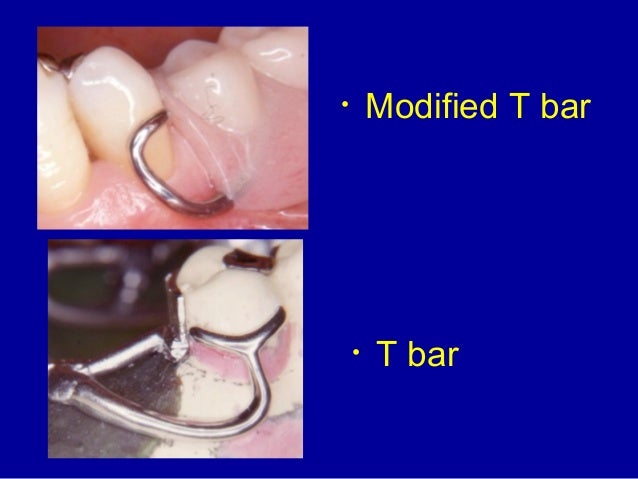 26. designing of rpd