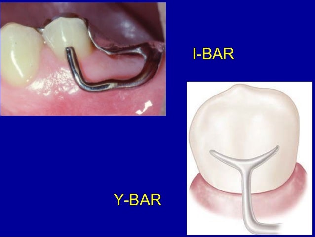 26. designing of rpd