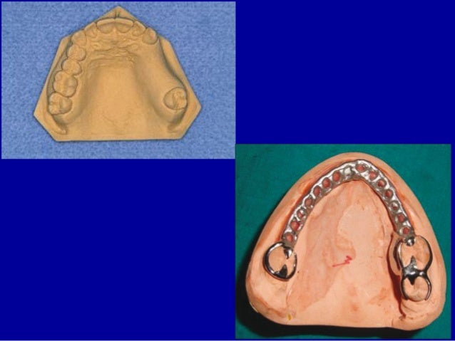 26. designing of rpd