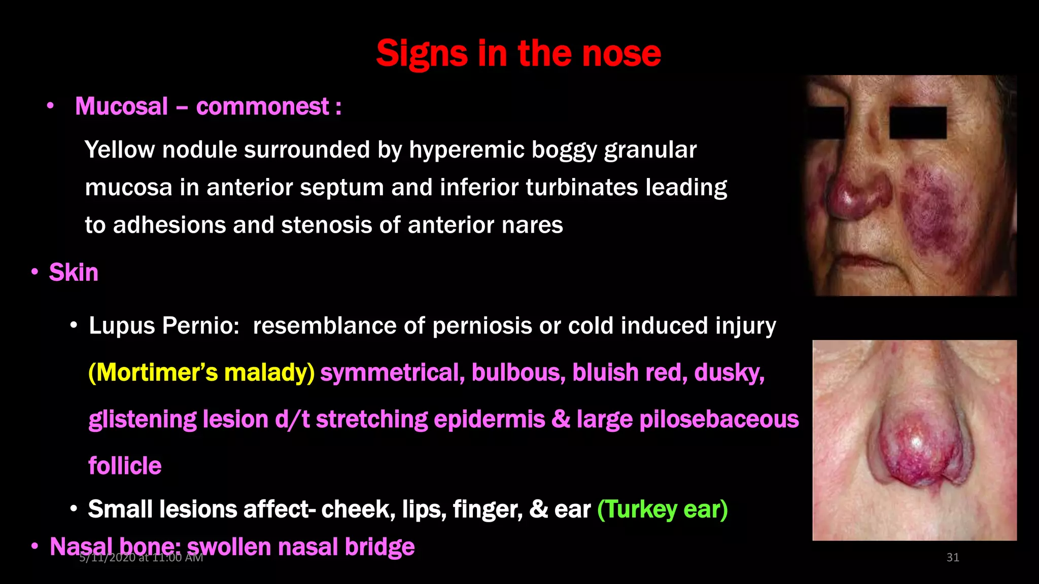 Otolaryngological manifestations of systemic diseases | PPTX