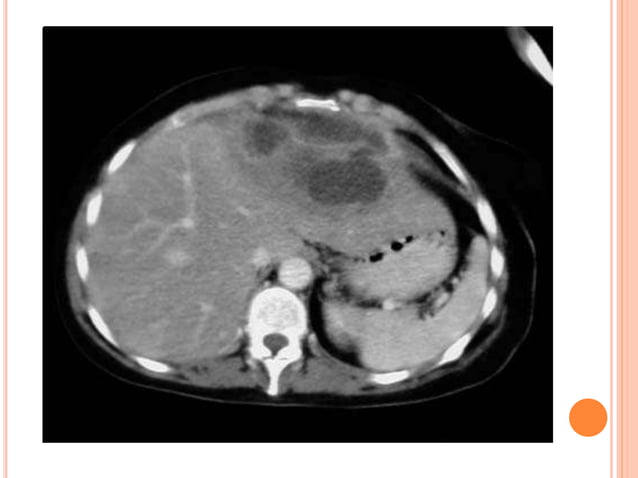 26. Liver Abscess.pptx | Digestive Disorders | Diseases and Conditions