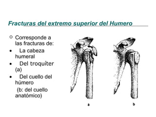 26. fractura de humero | PPT
