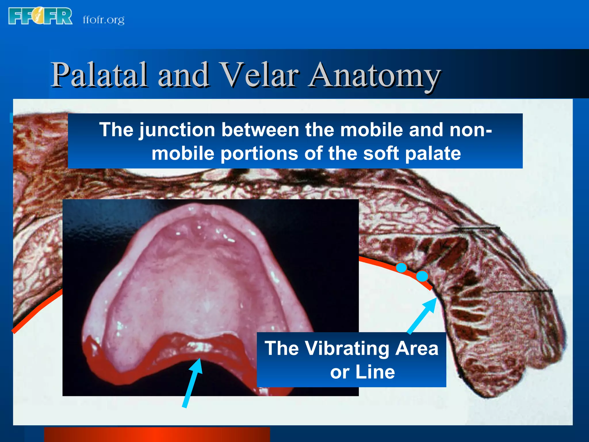 26.posterior palatal seal | PPT