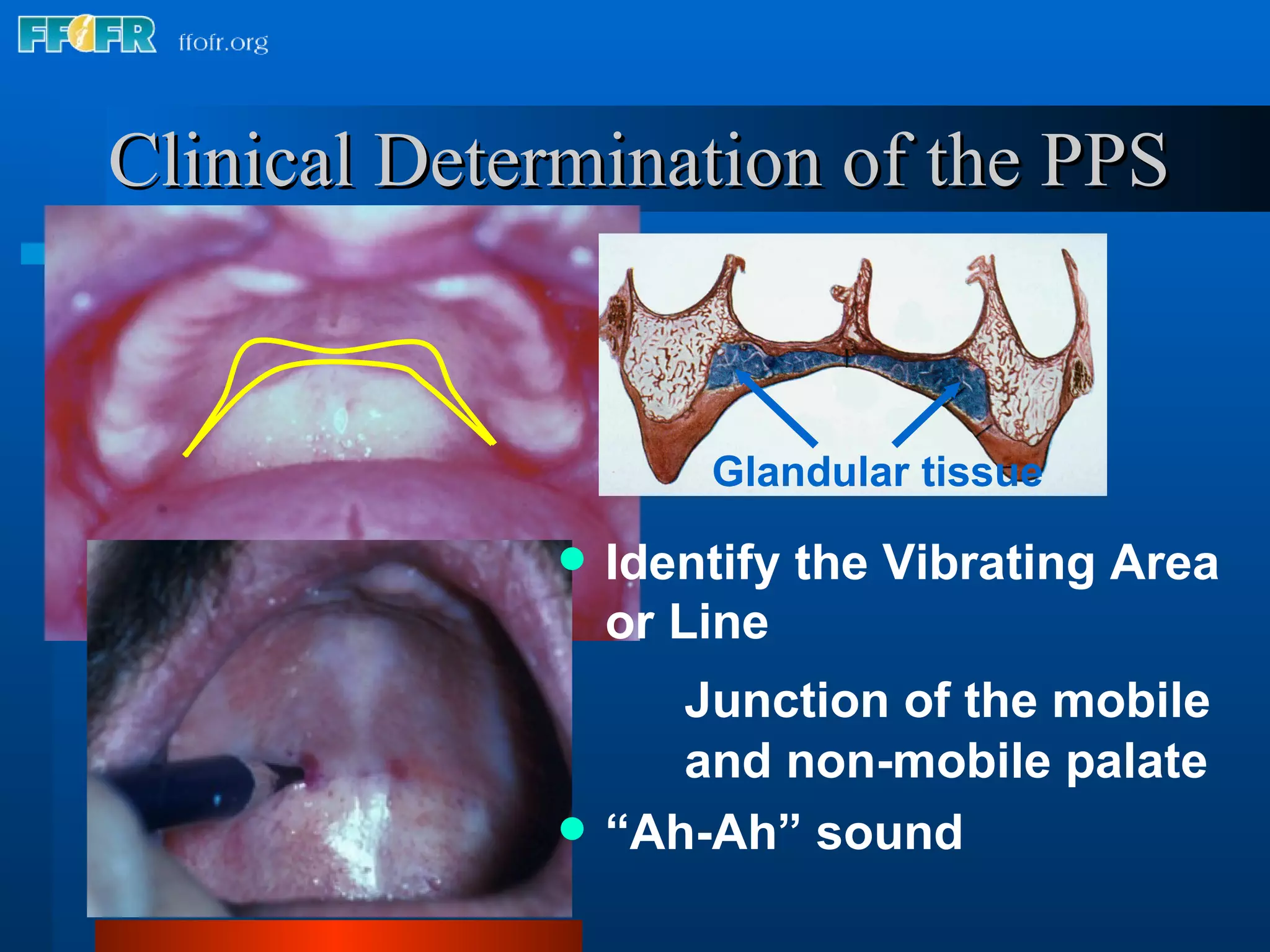 26.posterior palatal seal | PPT